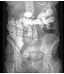 Tránsito del intestino delgado