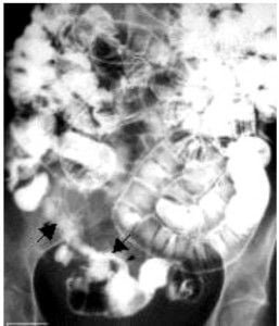 Tránsito del intestino delgado