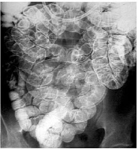 Tránsito del intestino delgado