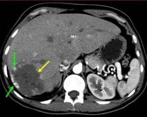 Patologías más frecuentes en TC Hepático - Imagen Diagnóstica y ...
